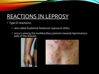 LEPROSY and Rehabilitation process of leprosy | PPTX