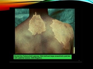 LEPROSY and Rehabilitation process of leprosy | PPTX