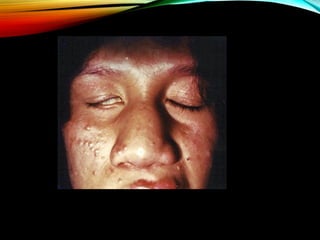 LEPROSY and Rehabilitation process of leprosy | PPTX
