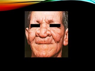 LEPROSY and Rehabilitation process of leprosy | PPTX