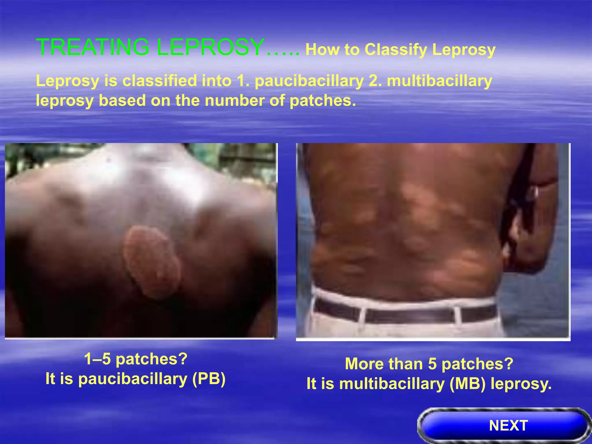 Leprosy presentation1 | PPSX