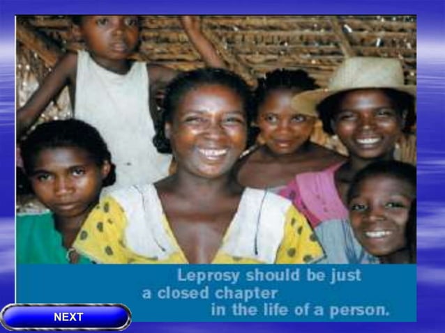Leprosy presentation1 | PPSX