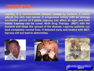 Leprosy presentation1 | PPSX