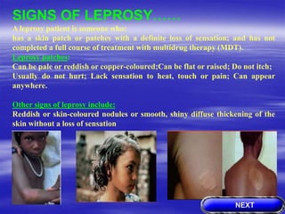 Leprosy presentation1 | PPSX