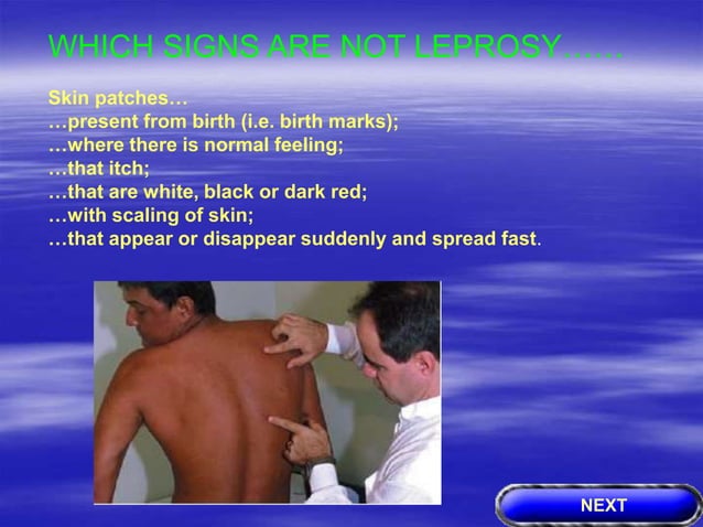 Leprosy presentation1 | PPSX
