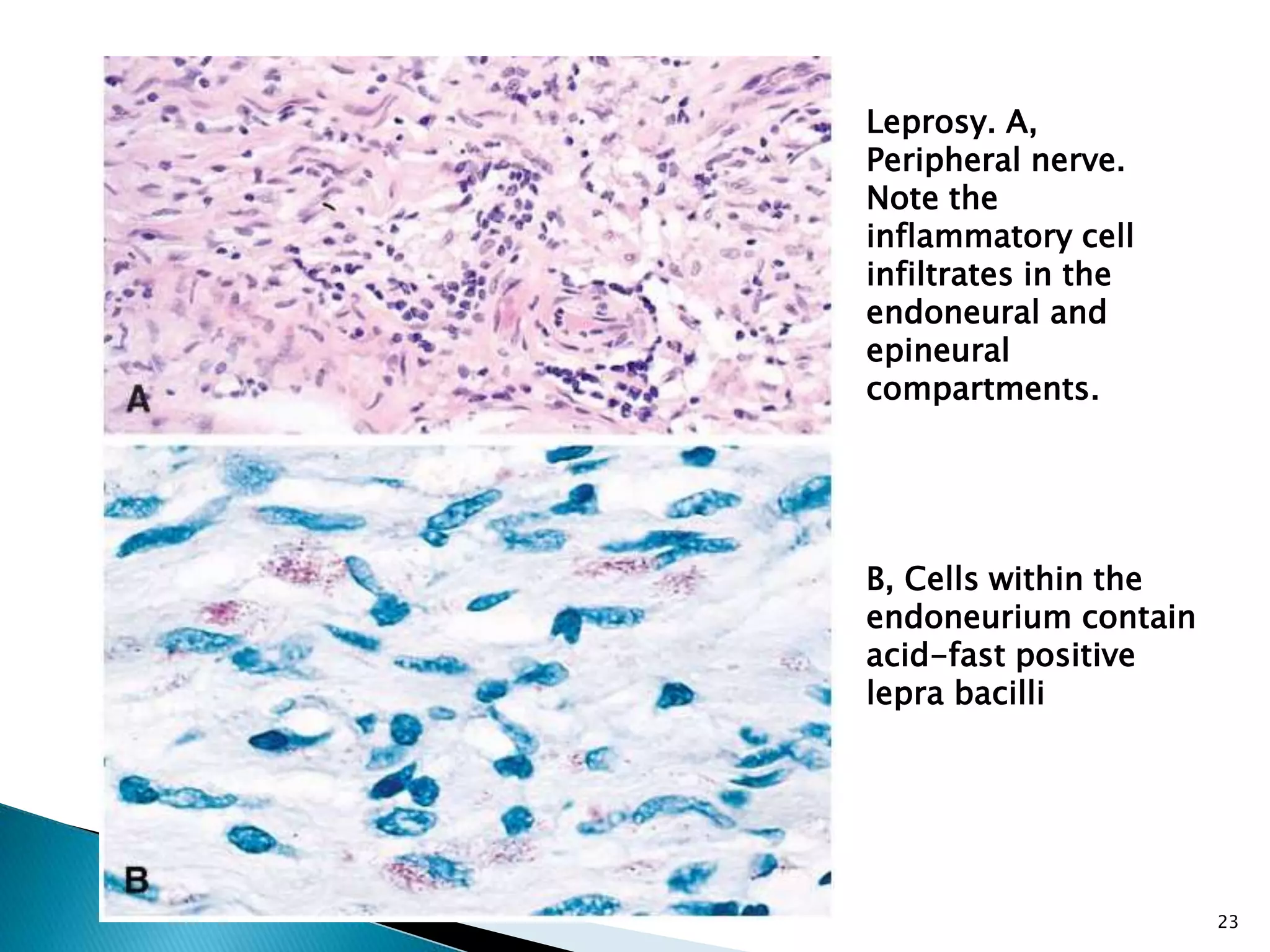 Leprosy & syphilis | PPTX