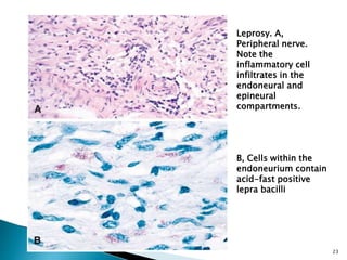 Neurosyphilis Histology