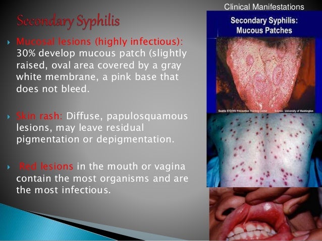 Leprosy & syphilis