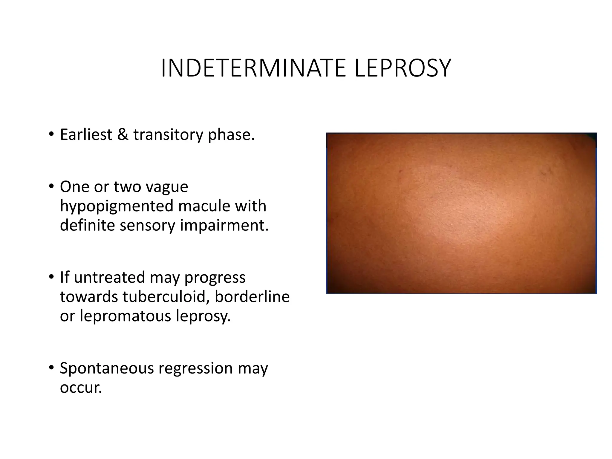 leprosysyphilis - LEPROSY & SYPHILIS.pptx