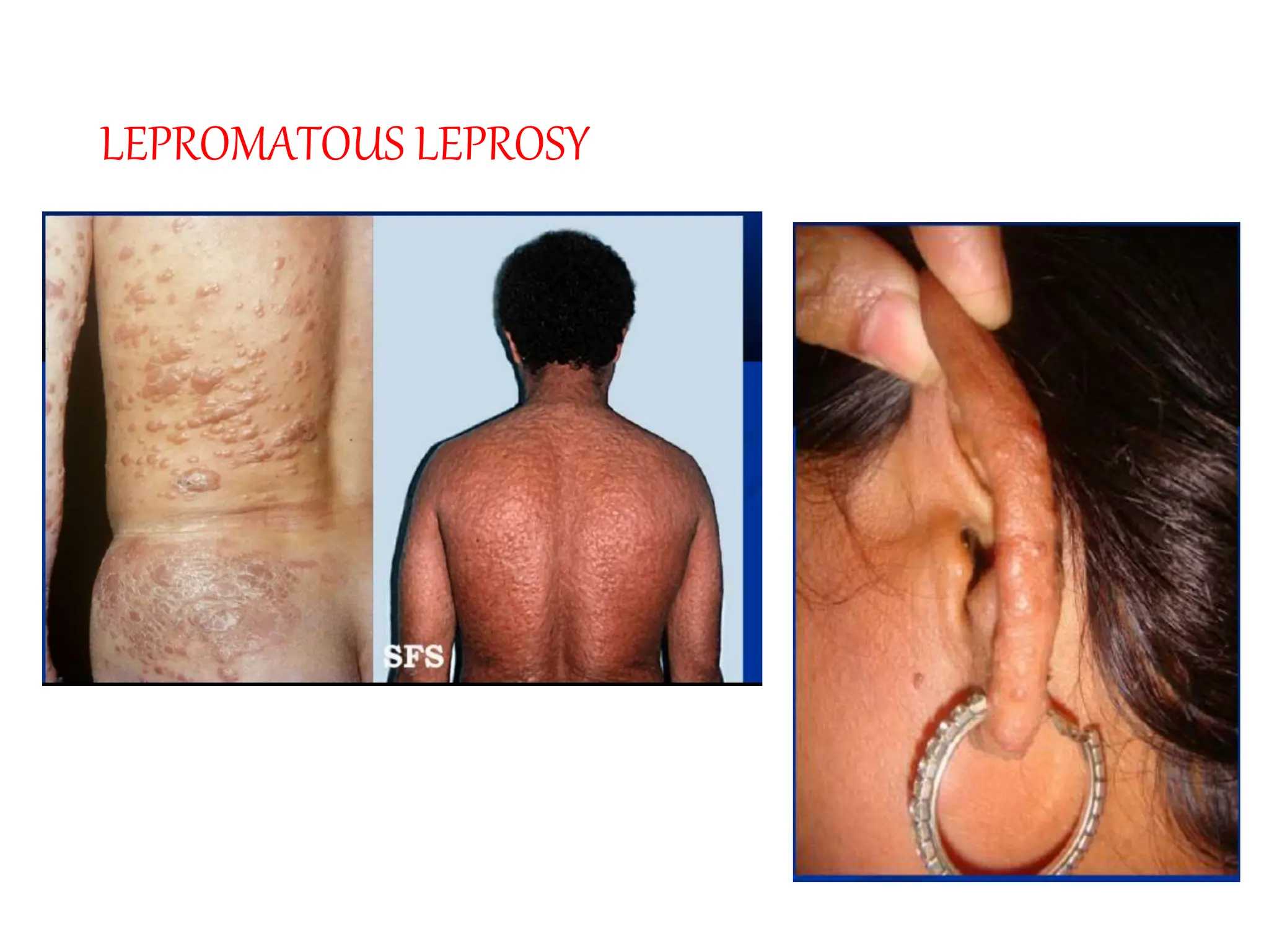 leprosysyphilis - LEPROSY & SYPHILIS.pptx