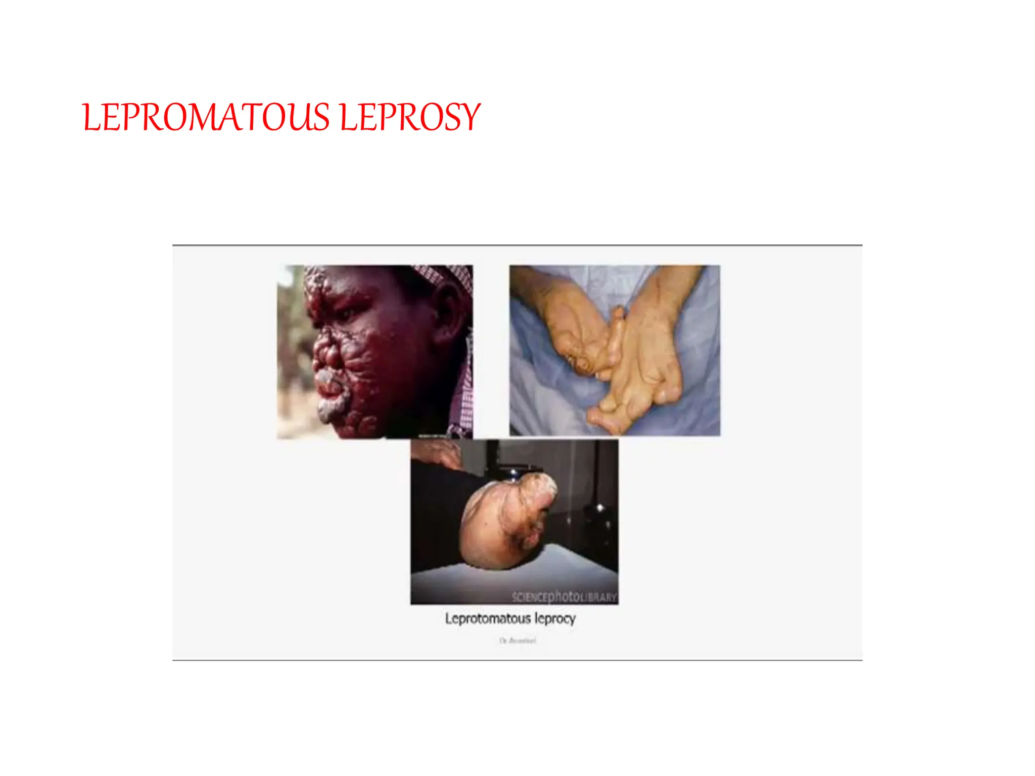 leprosysyphilis - LEPROSY & SYPHILIS.pptx