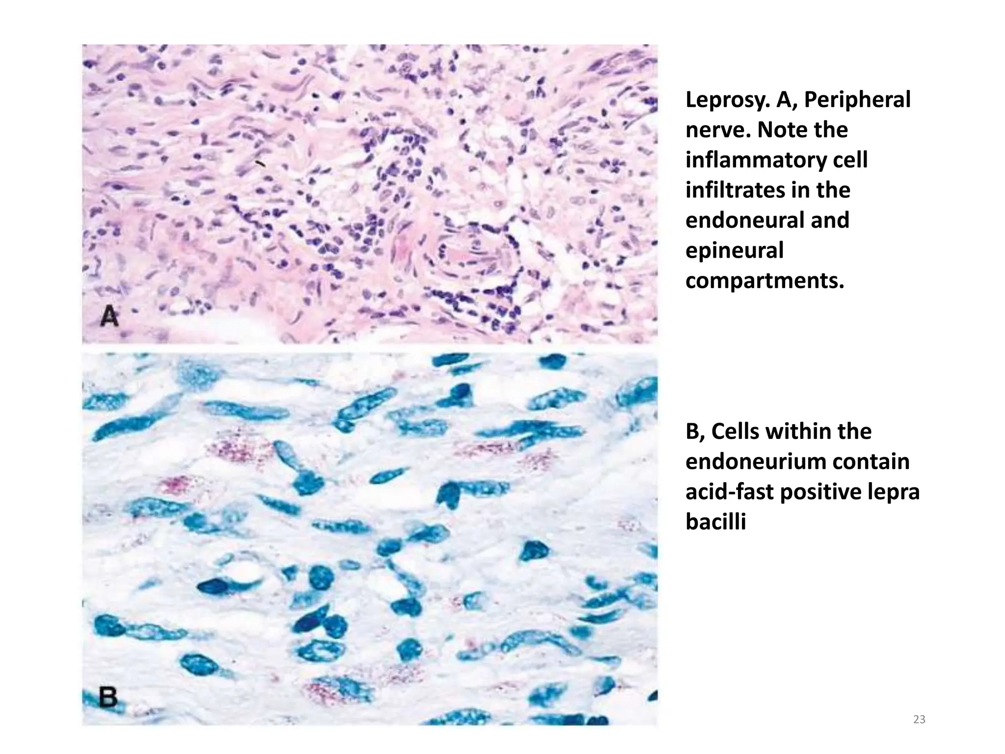leprosysyphilis - LEPROSY & SYPHILIS.pptx