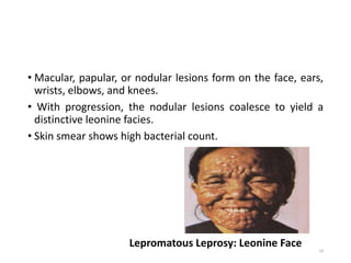 leprosysyphilis - LEPROSY & SYPHILIS.pptx
