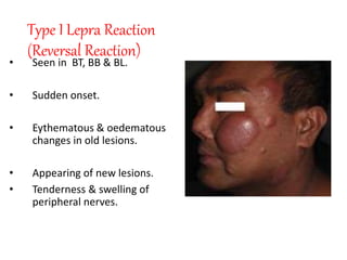 leprosysyphilis - LEPROSY & SYPHILIS.pptx
