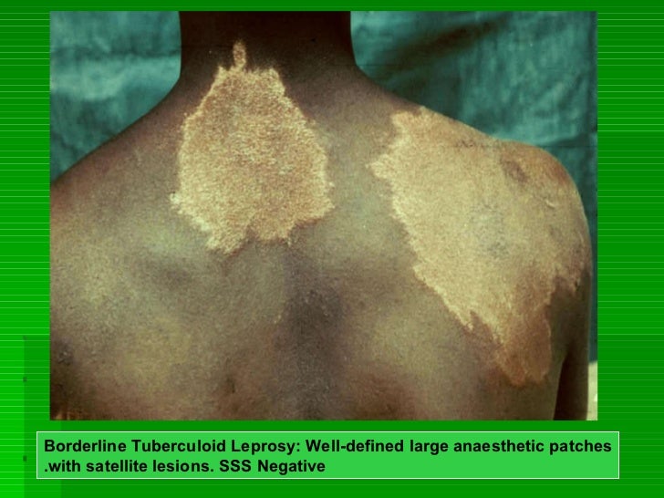 Leprosy For Undergraduate Medical Students leprosy-for-undergraduate-medical-students