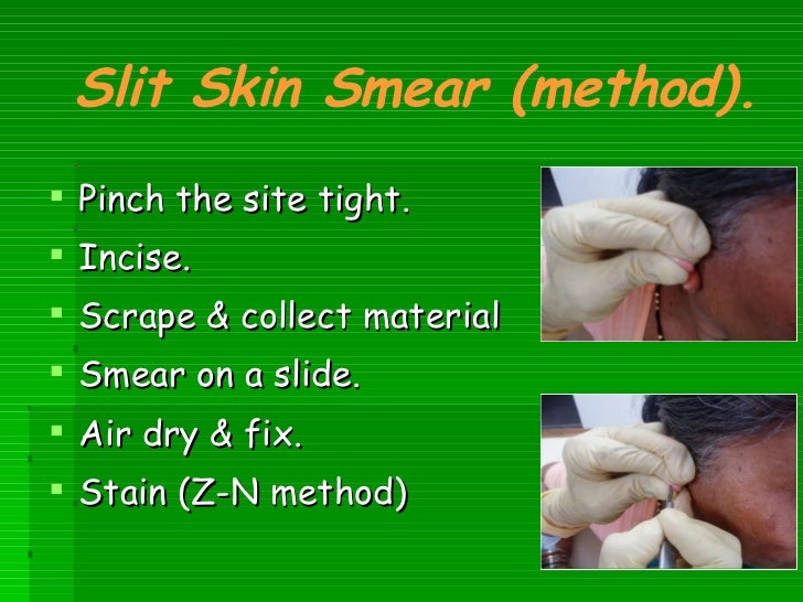 Leprosy for undergraduate medical students