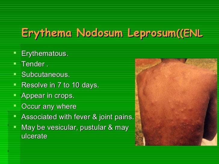 Leprosy for undergraduate medical students