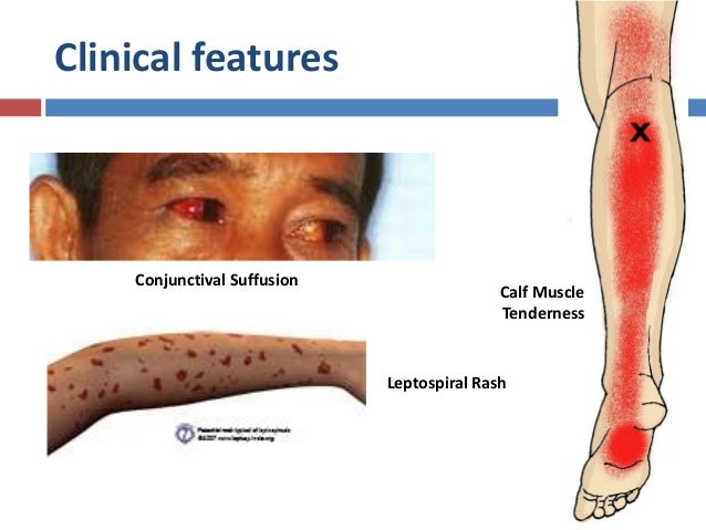 Leptospirosis a neglected infectious disease in the tropics