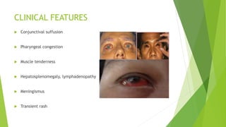 LEPTOSPIROSIS INFECTION IN CLINICAL ASPECT | PPT