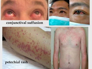 Leptospirosis Rash
