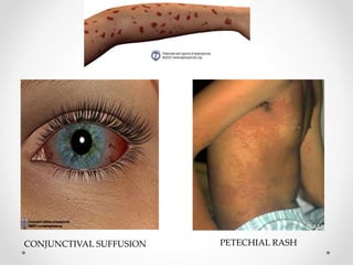 Leptospirosis Rash