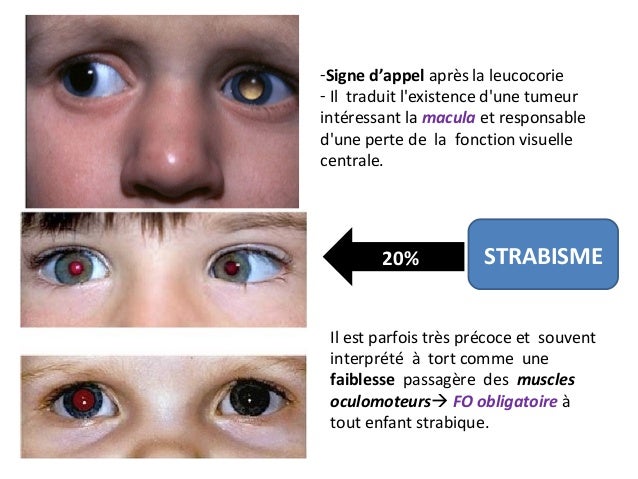 Le rétinoblastome (rb)