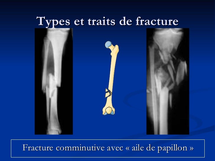 Les fractures osseuses