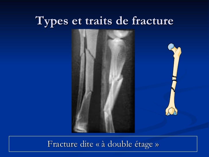Les fractures osseuses