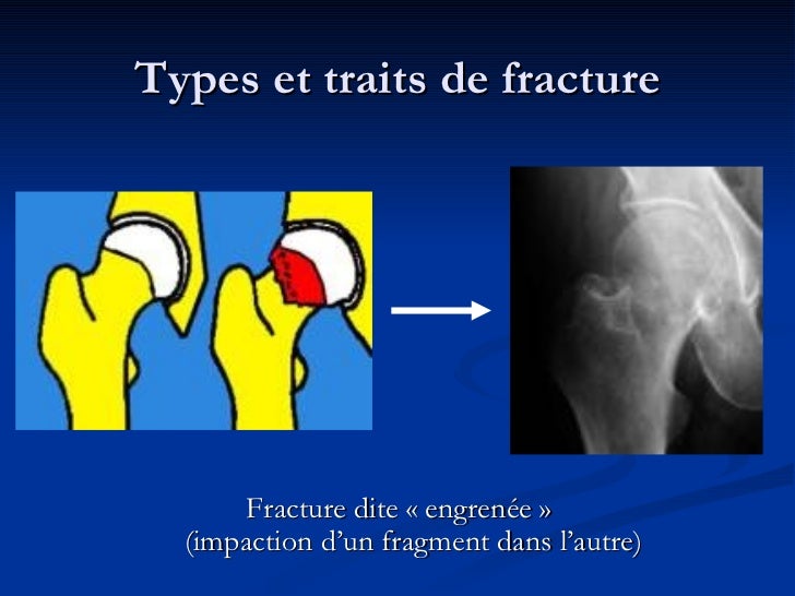 Les fractures osseuses