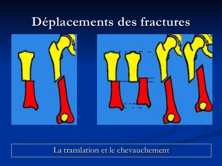 Quelle Est La Différence Entre Fracture Spontanée Et Fracture Ouverte ...