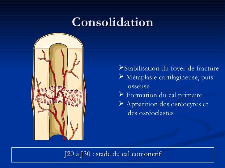 Def Cal Osseux – Cal sur l’os : causes, objectif, délai de guérison – QMHAN