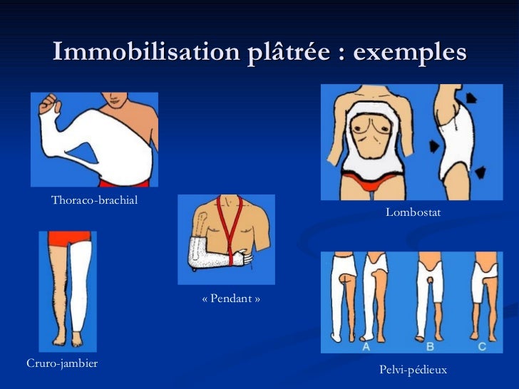 Les fractures osseuses