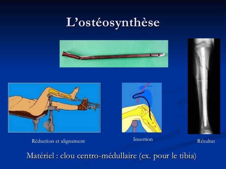 Les fractures osseuses