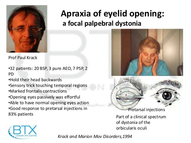 The start of the Botulinum toxin in neurology in France by Dr Marie-H…