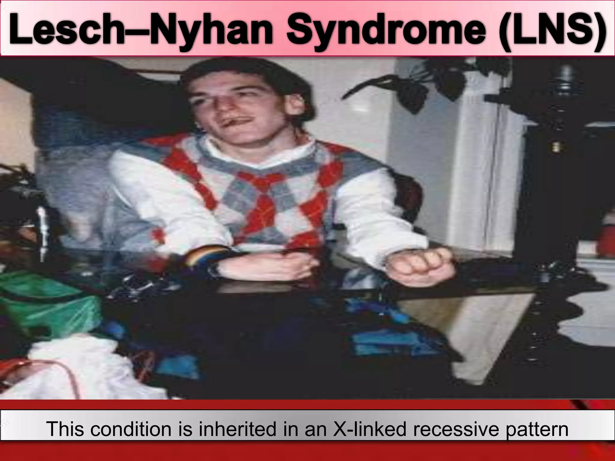 Lesch–nyhan syndrome | PPTX