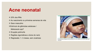 Lesões Cutâneas do RN | PPTX