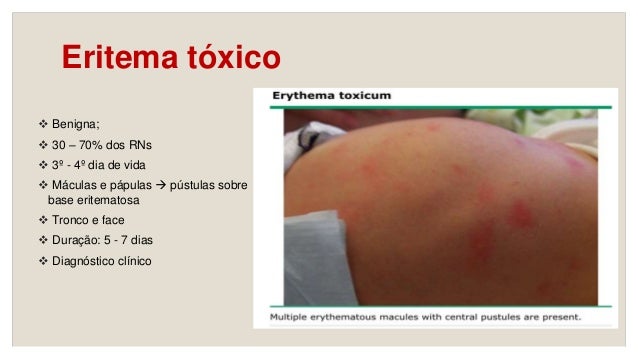 Lesões Cutâneas do RN