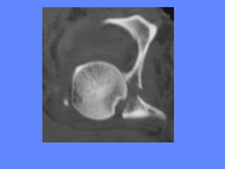 Comprehensive Overview of Acetabular (Cotyle) Fractures: Diagnosis ...