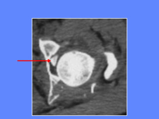Comprehensive Overview of Acetabular (Cotyle) Fractures: Diagnosis ...