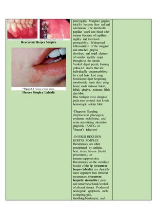 Lesi Rongga Mulut Akibat Virus | DOCX