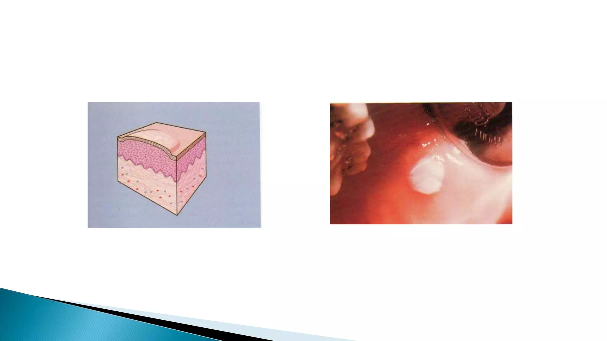 Lesi dasar mulut | PPTX