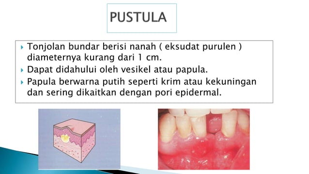 Lesi dasar mulut | PPTX