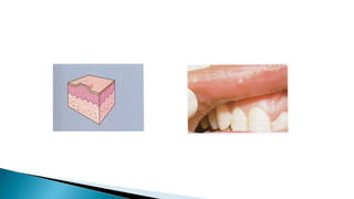 Lesi dasar mulut | PPTX