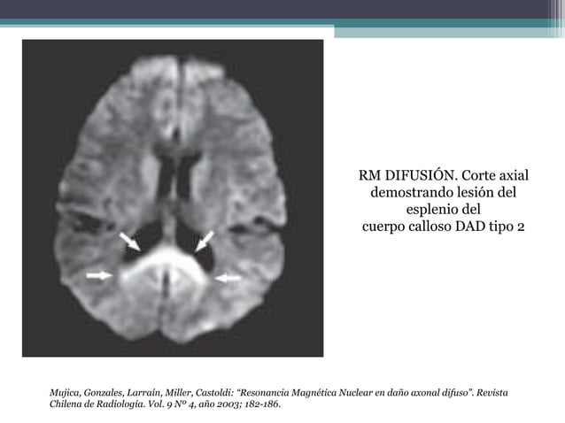 Lesión axonal difusa | PPT