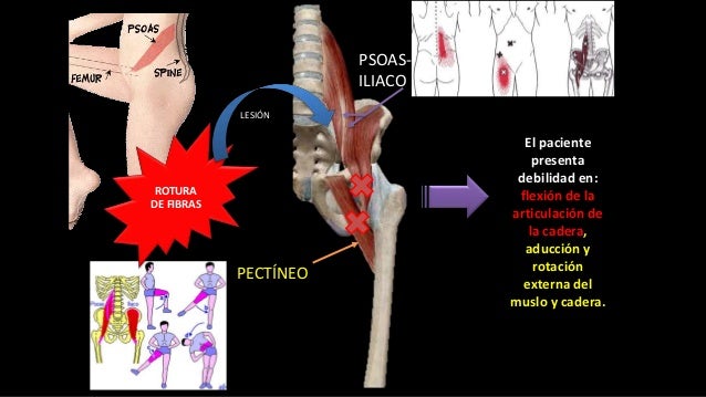 LESIÓN PARCIAL DE ARTERIA FEMORAL A NIVEL DEL TRIÁNGULO DE SCARPA