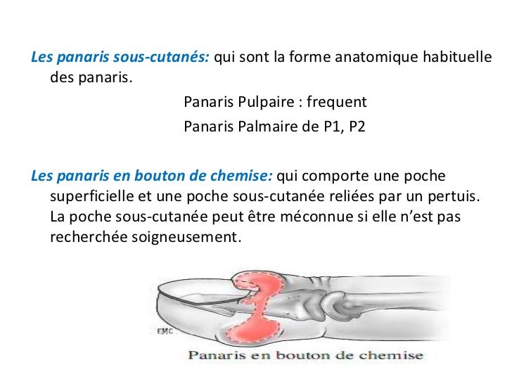 Les infections de la main