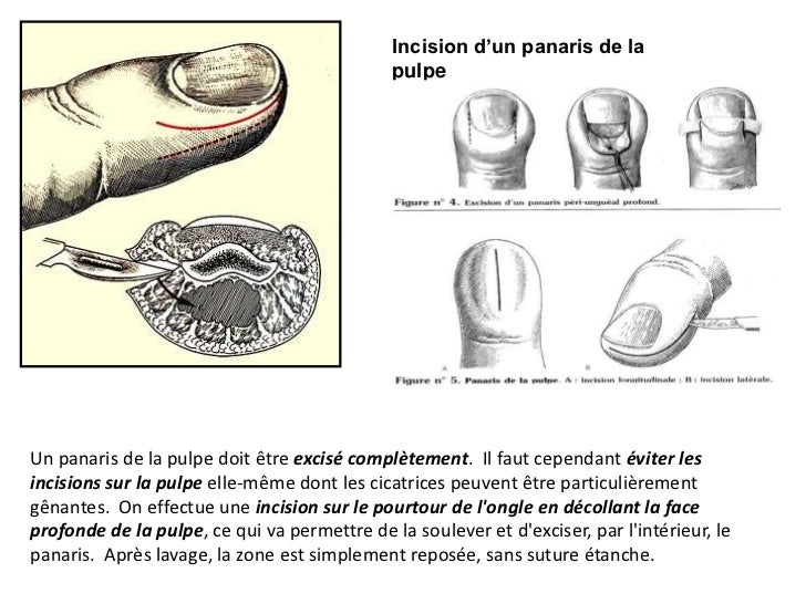 Les infections de la main