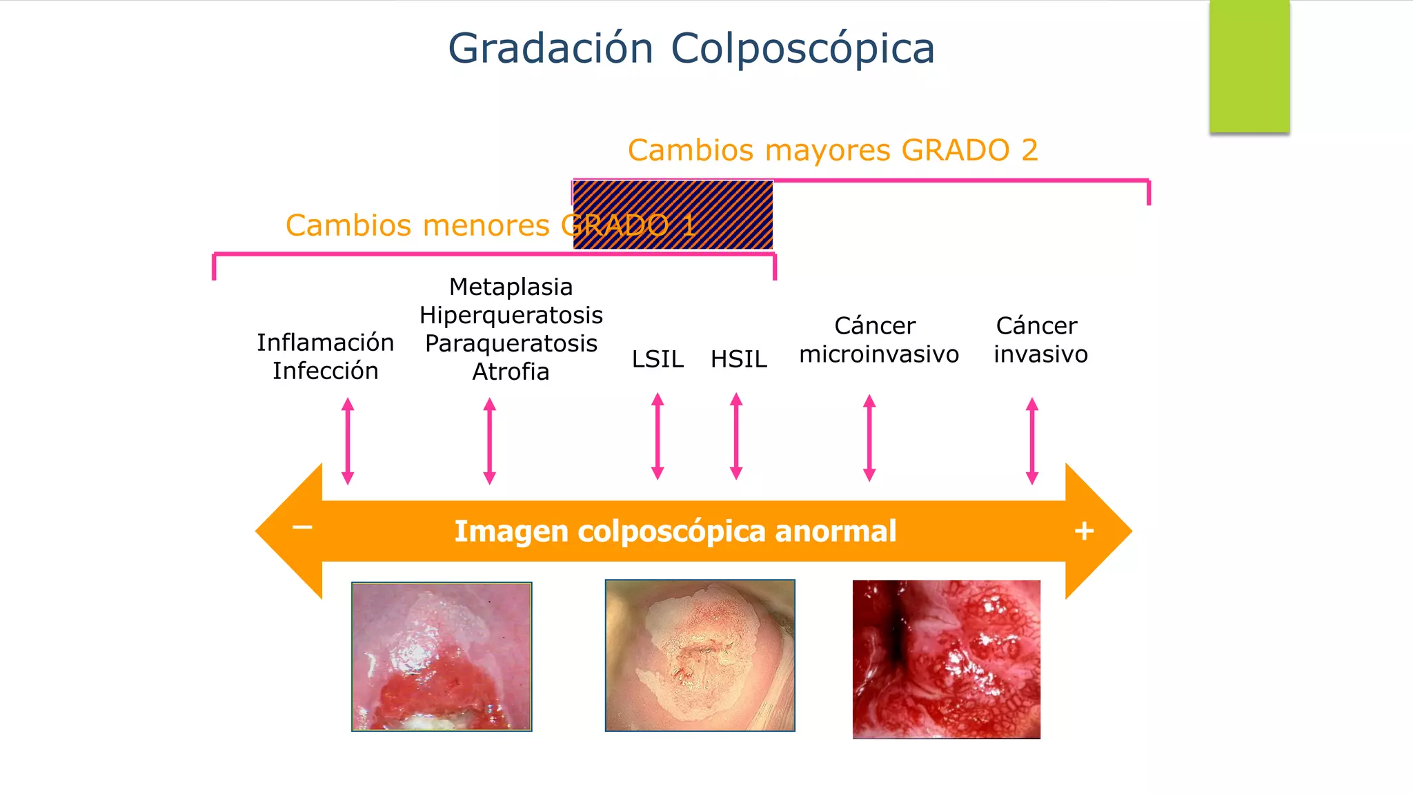 Lesión intraepitelial de alto grado LIEAG - Diagnostico y manejo - vph ...