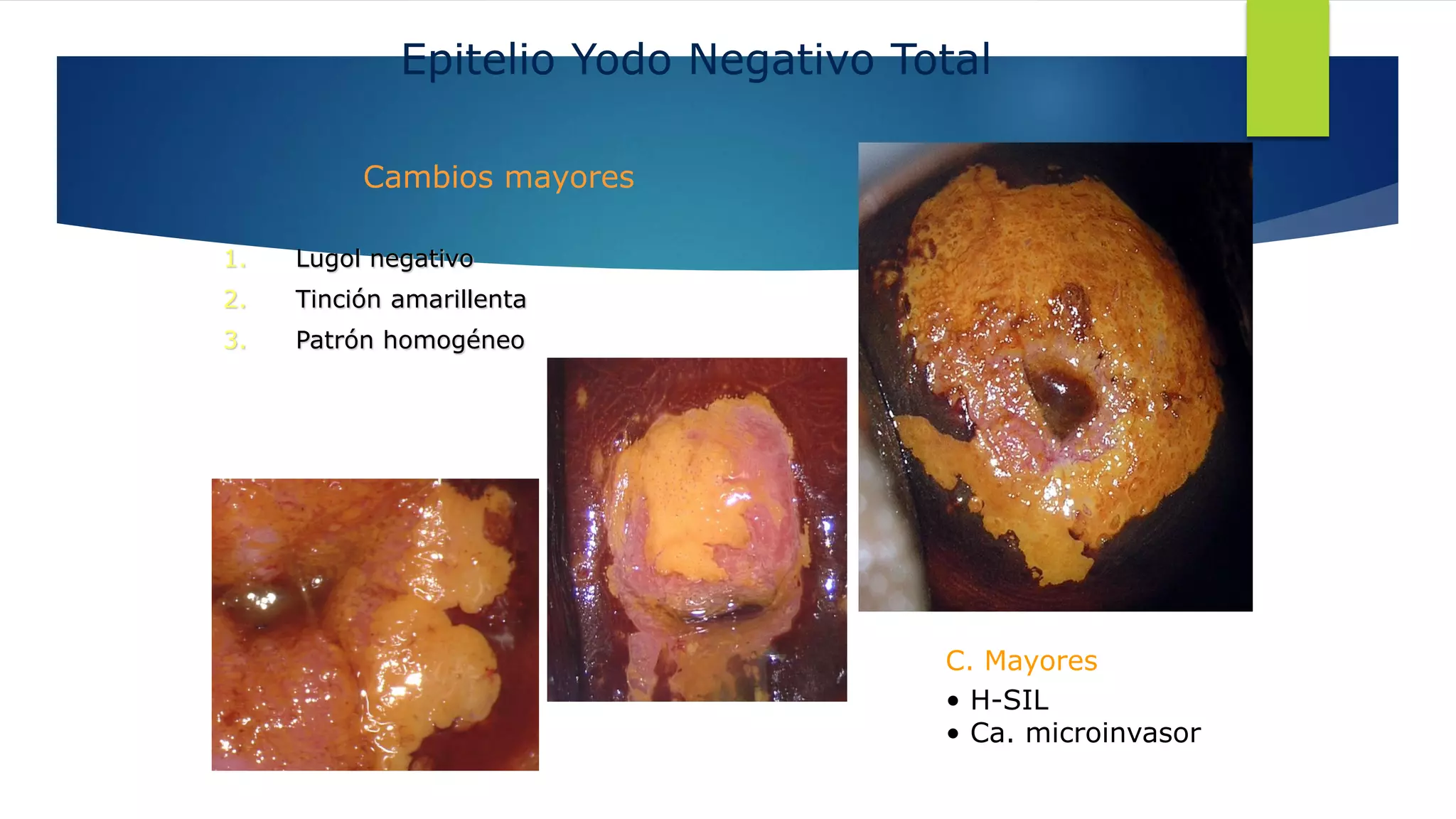 Lesión intraepitelial de alto grado LIEAG - Diagnostico y manejo - vph ...