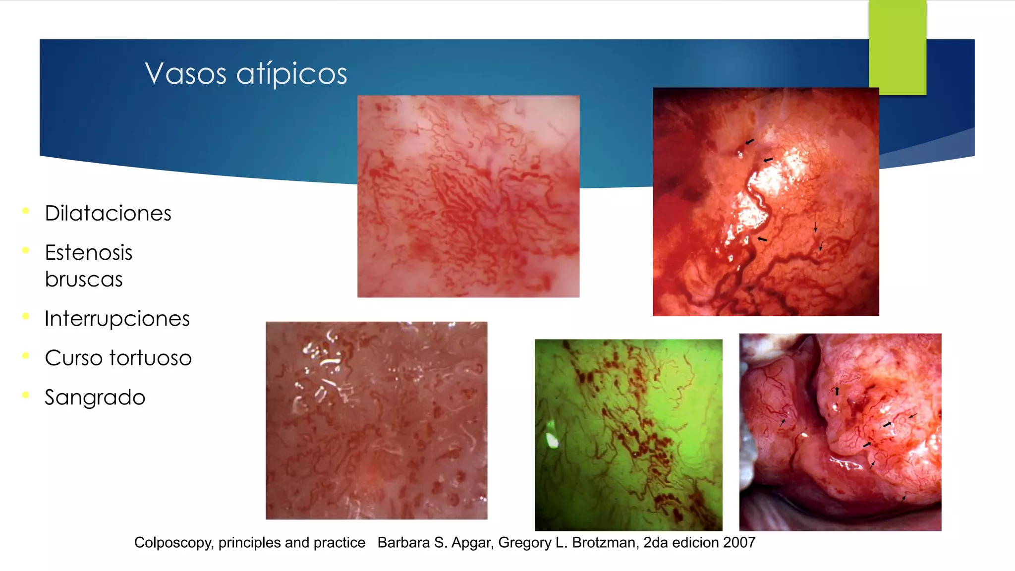 Lesión intraepitelial de alto grado LIEAG - Diagnostico y manejo - vph ...
